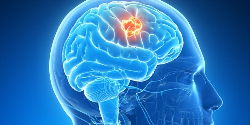 Beyin Tümörü Belirtileri Nelerdir? – Prof. Dr. Bülent Canbaz – Beyin ve ... Beyin Tümörü Belirtileri Nelerdir? – Prof. Dr. Bülent Canbaz – Beyin ve ...